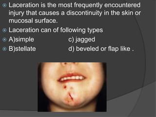 Oral and maxillofacial injuries | PPTX