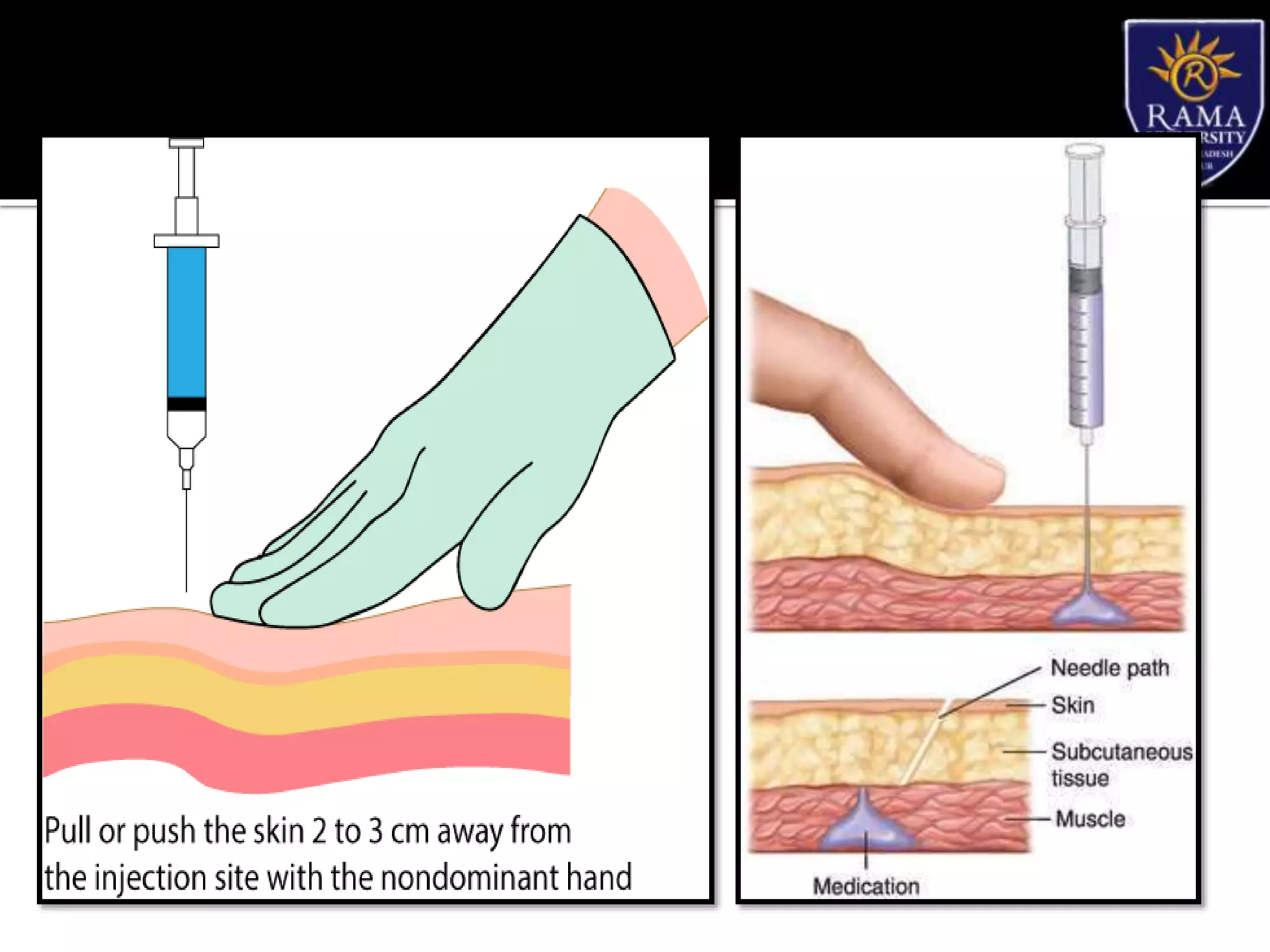 Oral , Parentral and Topical Route (Fundamental of Nursing) | PPTX
