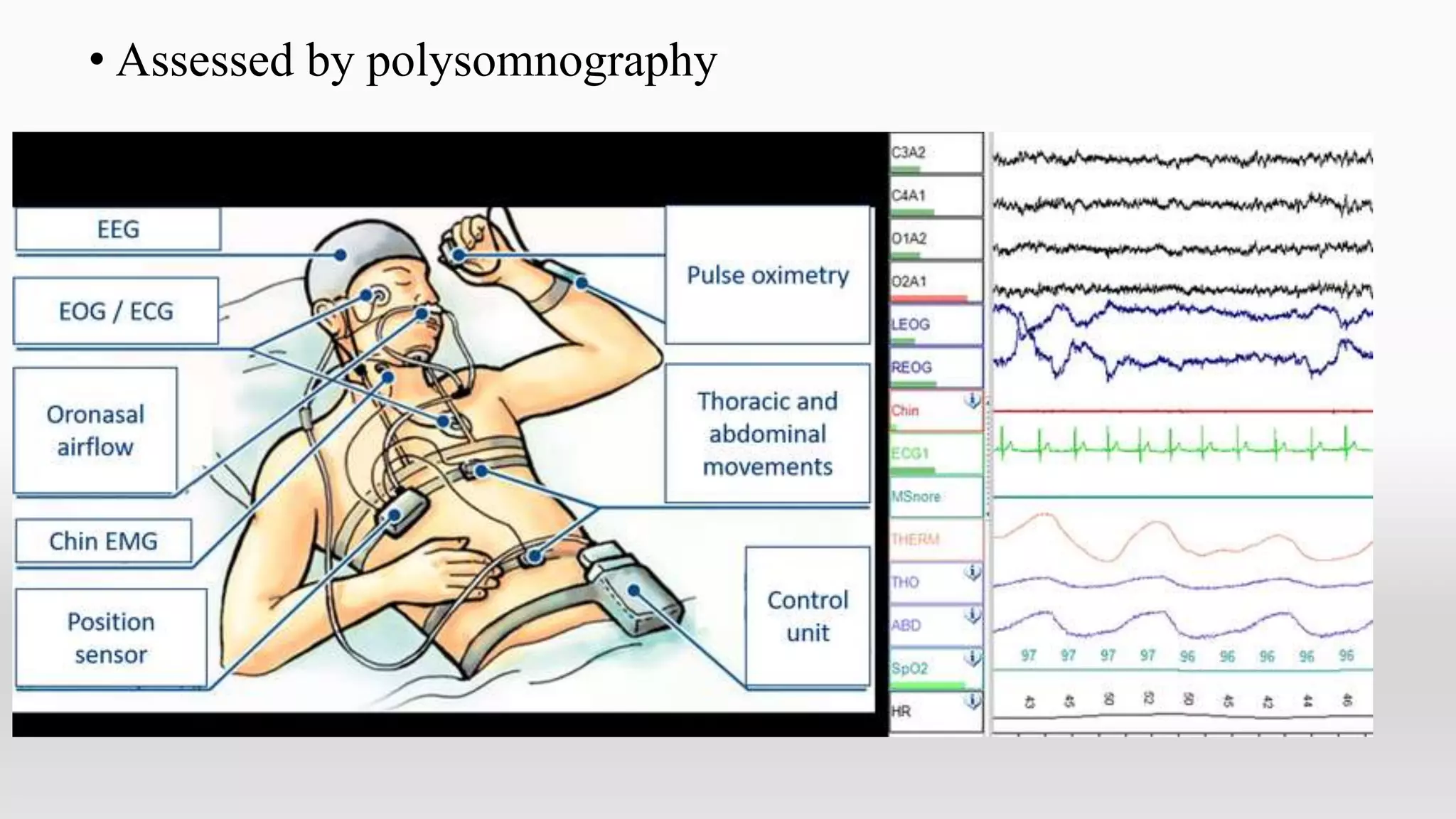 Prosthetic Management of sleep apnea and snoring | PPTX