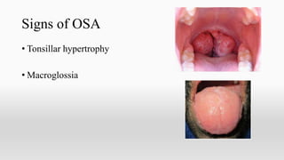 Prosthetic Management of sleep apnea and snoring | PPTX