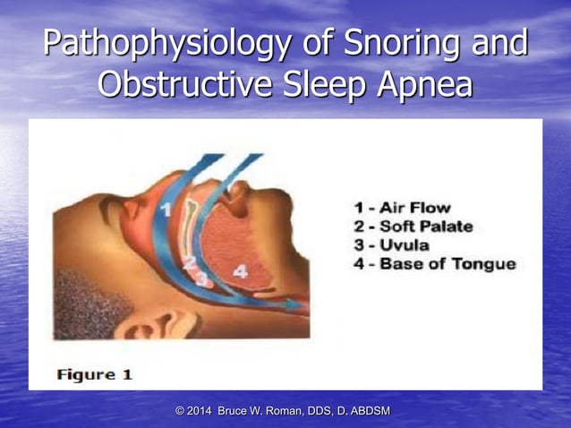 Oral Appliances for Snoring and Obstructive Sleep Apnea | PDF | Ear, Nose and Throat Conditions ...