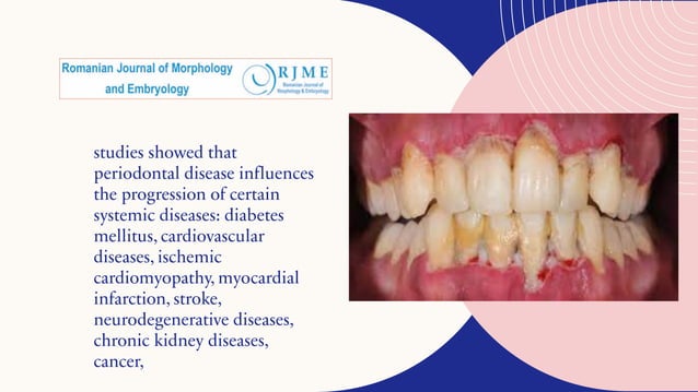 oral bio2 histopathology of periodontitis.pdf | Dental Health ...