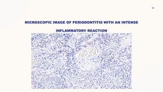 oral bio2 histopathology of periodontitis.pdf