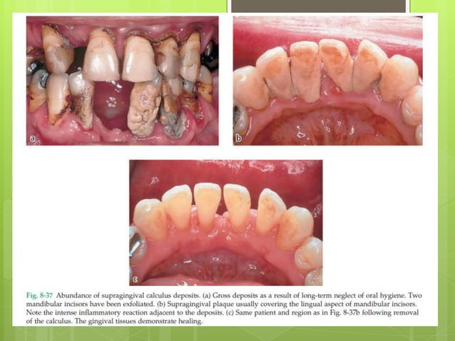 Oral biofilm and calculus.pdf