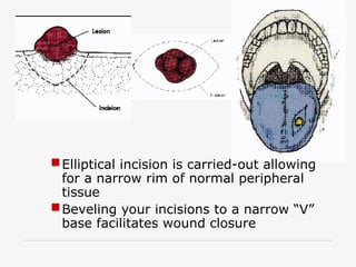 Oral Biopsy Brush, Aspirate, Incisional and Excisional | PPT
