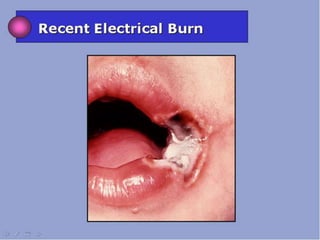 Oral burn | PPTX