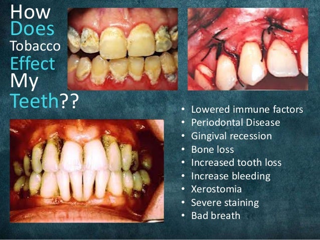 The Dangers of Tobacco Use in Oral and Systemic Health