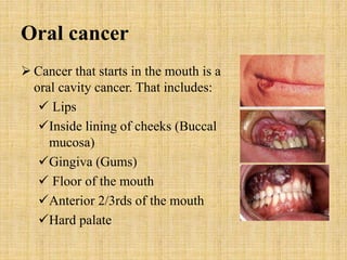 Oral cancer | PPTX