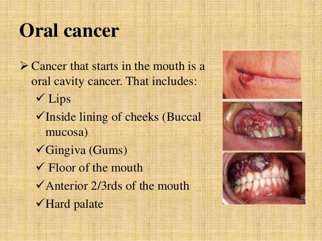 Oral cancer