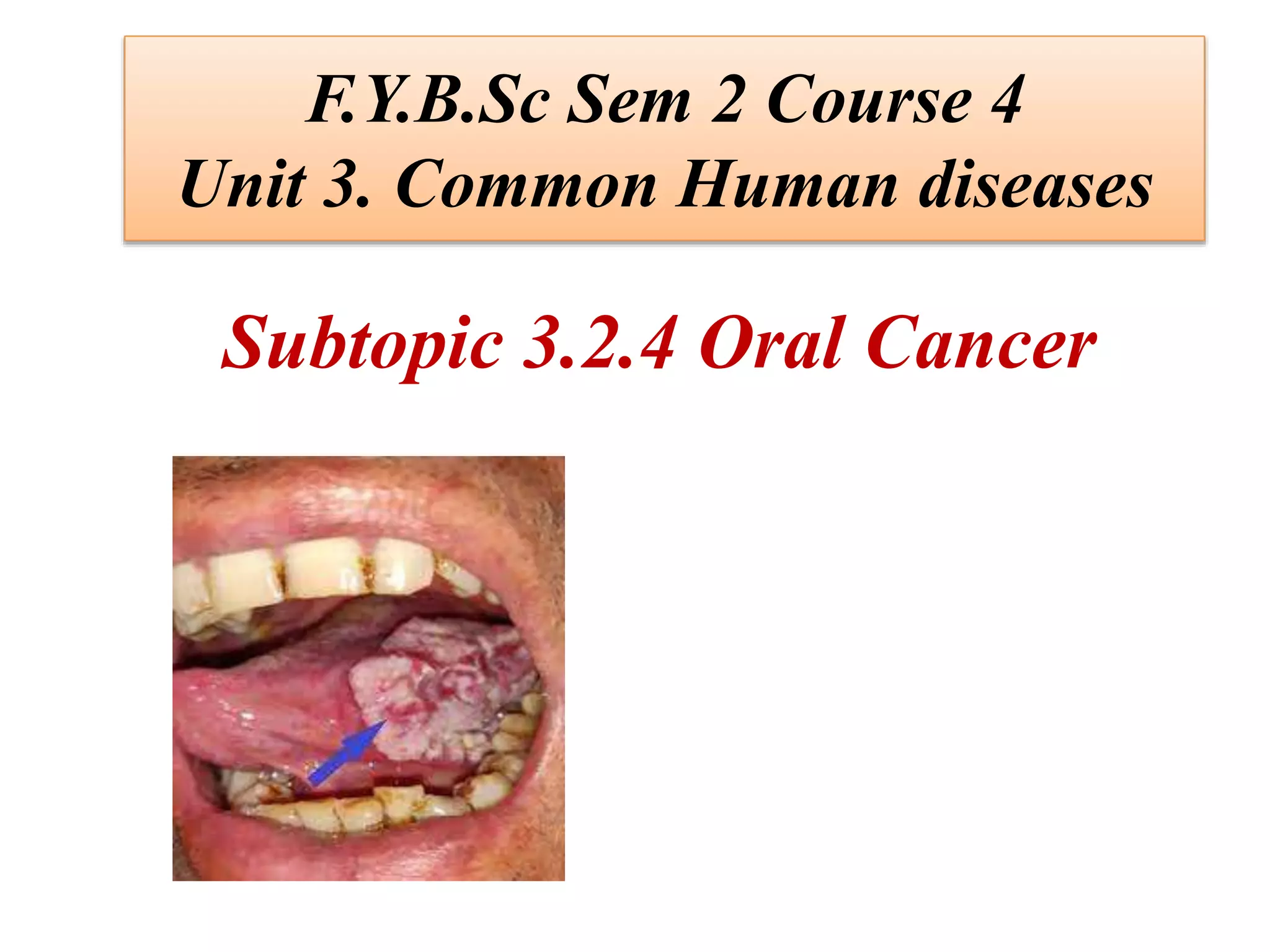 Oral cancer | PPTX