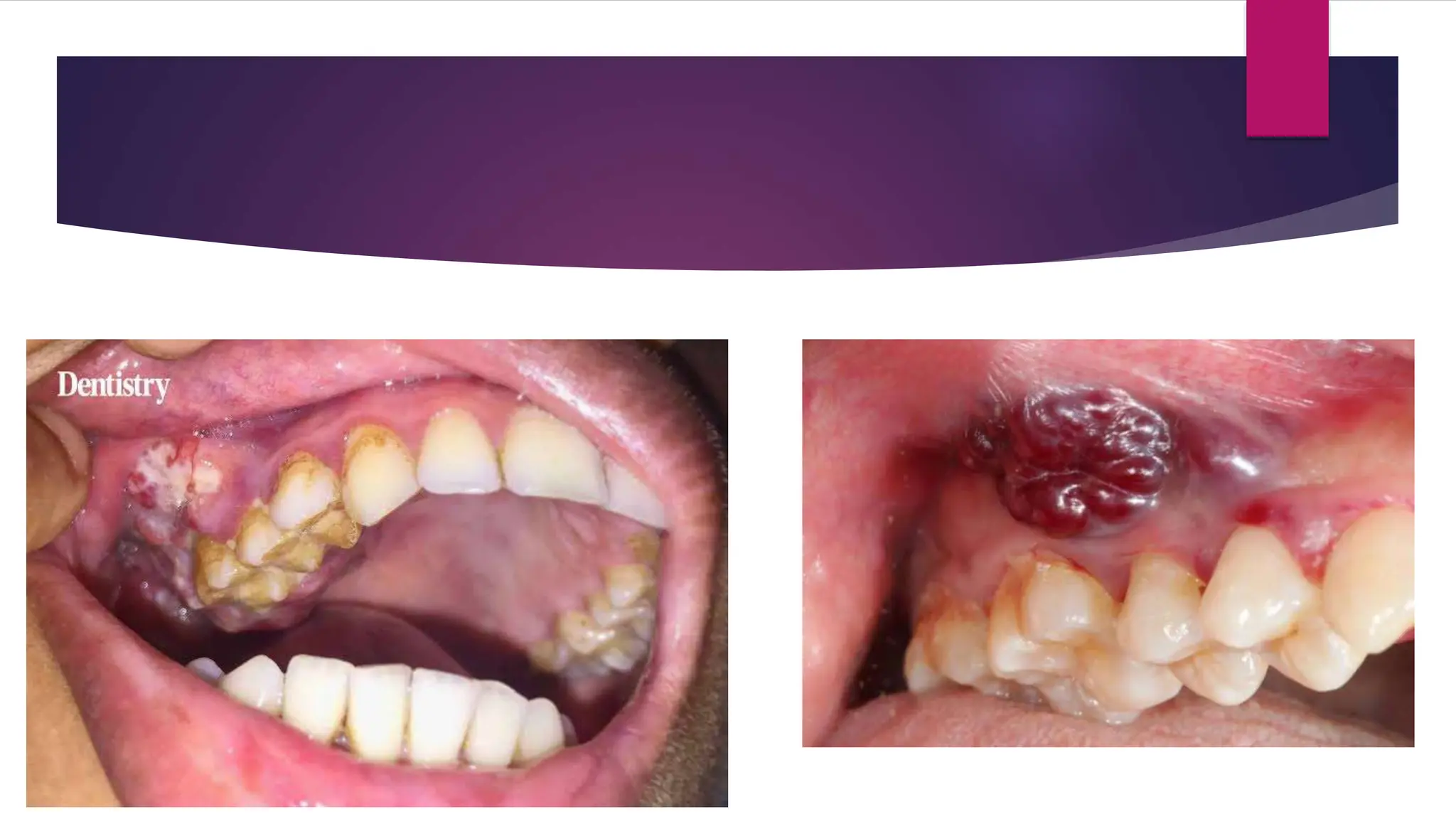 oral cancer , stomatitis, its management.pptx