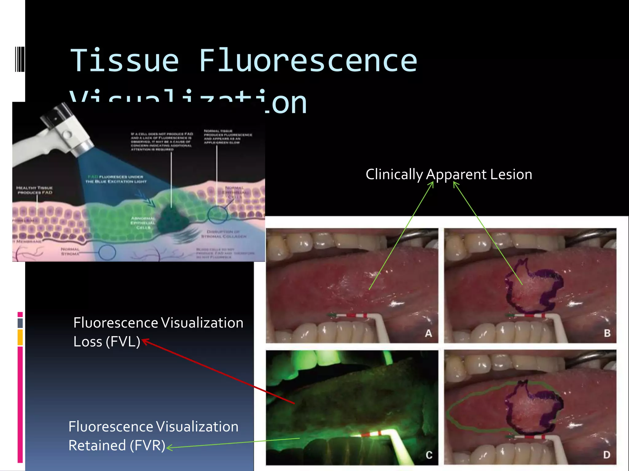 Oral cancer ,field cancerization dr mnr | PPTX