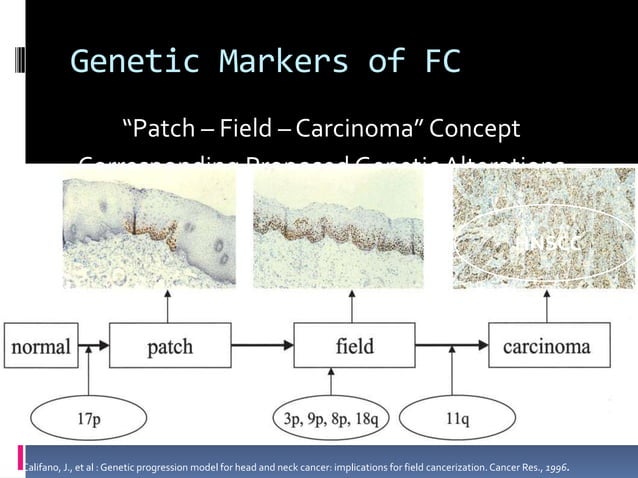 Oral cancer ,field cancerization dr mnr | PPTX | Cancer | Diseases and ...