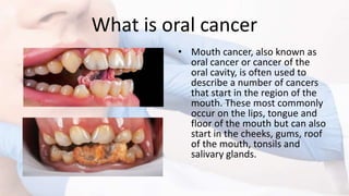 Oral Cancer Ishfaq.pptx