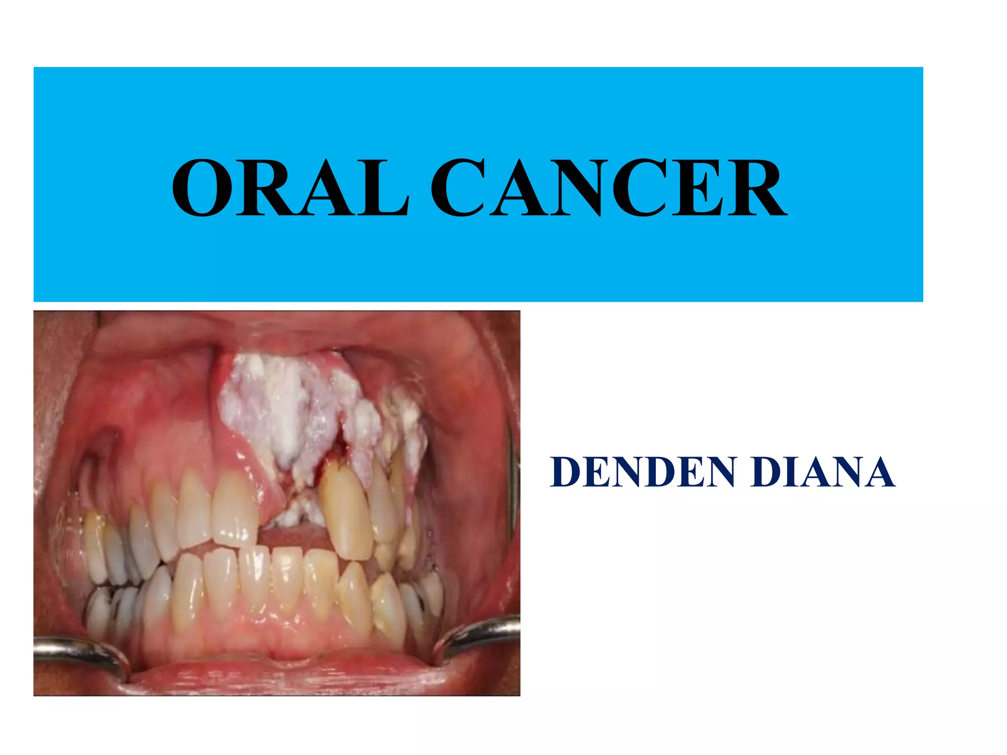Oral Cancer Ppt Pptx