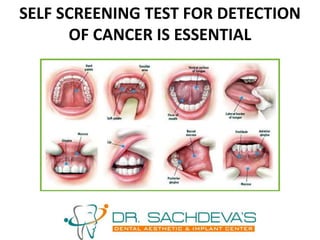 Oral cancer | PPTX