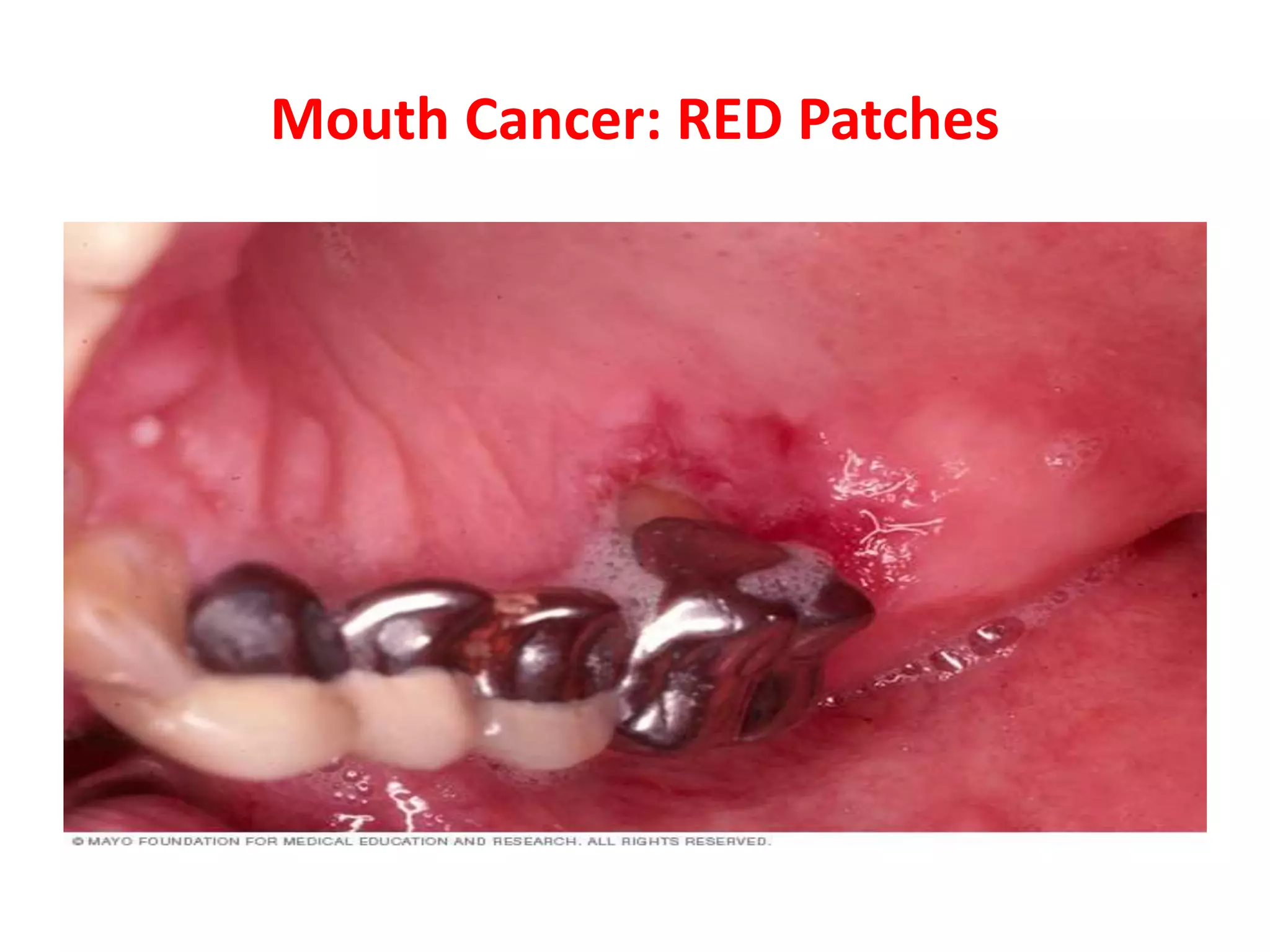 ORALCANCER PPT by Prof Vijayreddy Principal SGJ CON.pptx