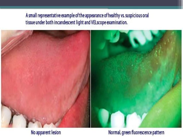 oral cancer screening LECTURE,,,,,,,,,,, | PPTX