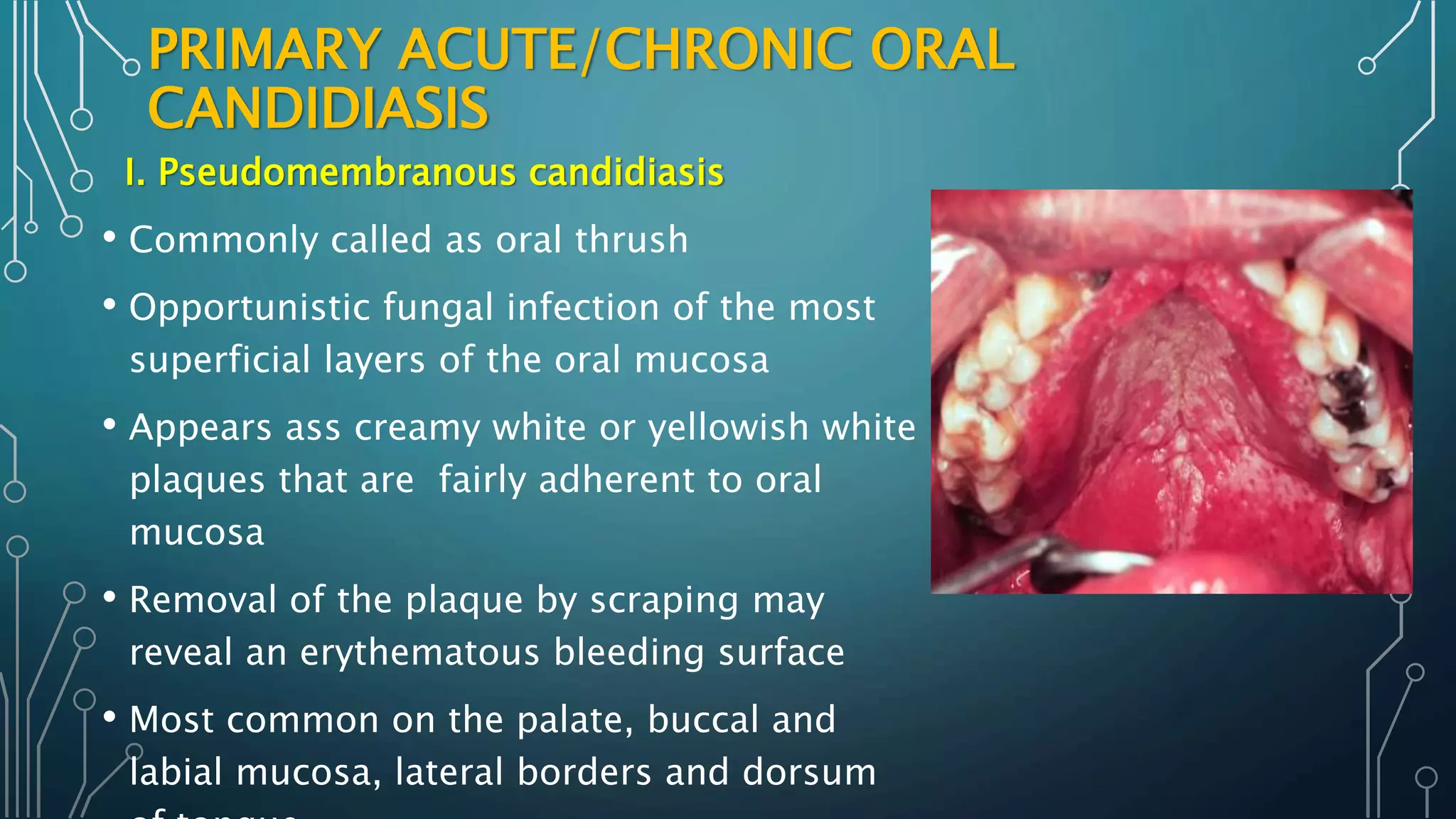 Oral candidiasis | PPTX