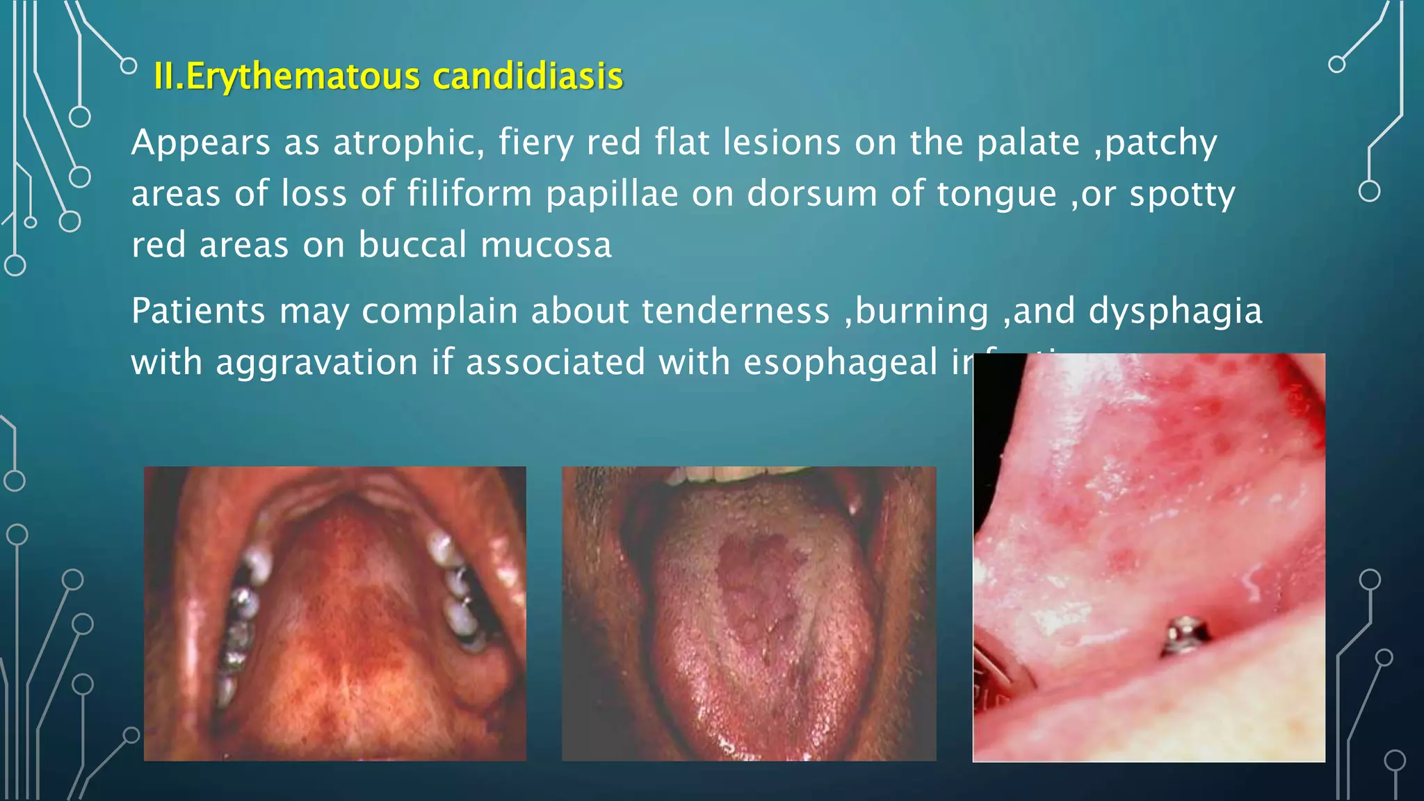 Oral candidiasis | PPTX