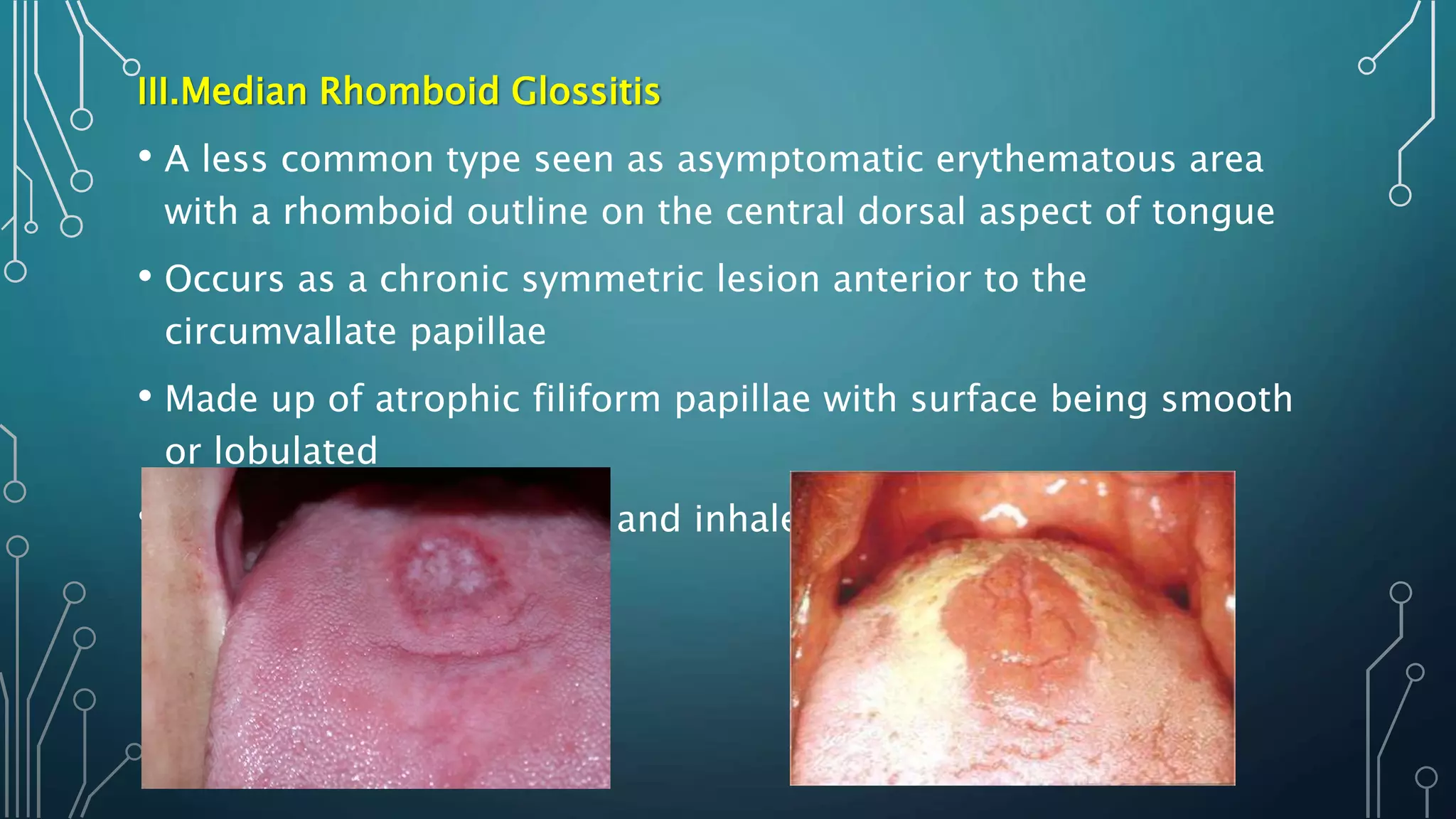 Oral candidiasis | PPTX