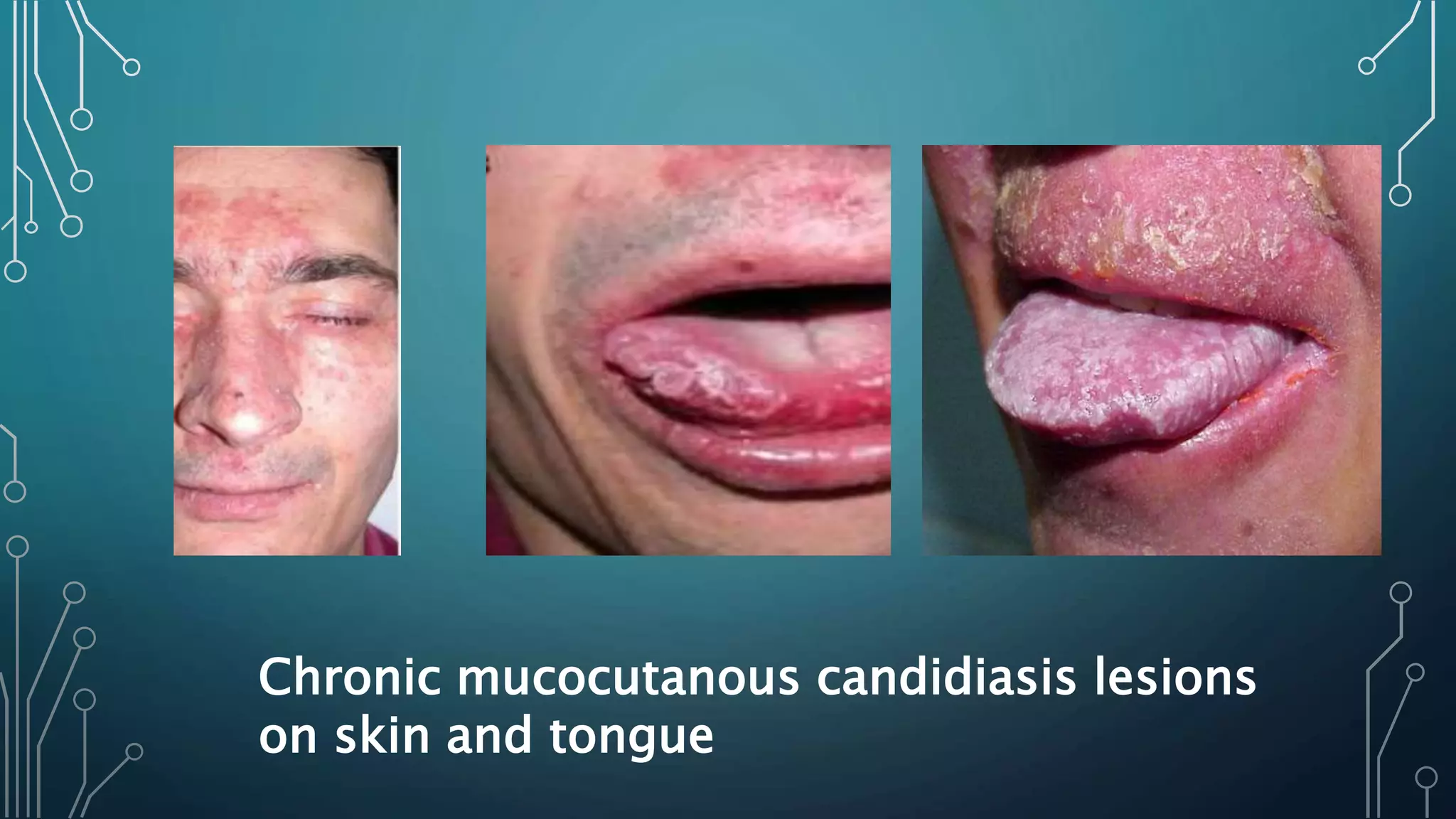 Oral candidiasis | PPTX