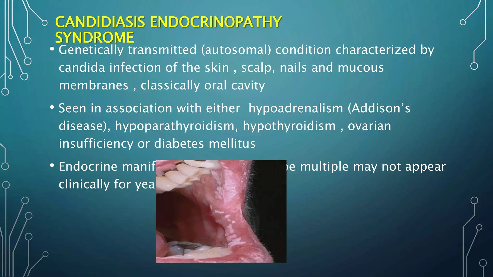 Oral candidiasis | PPTX