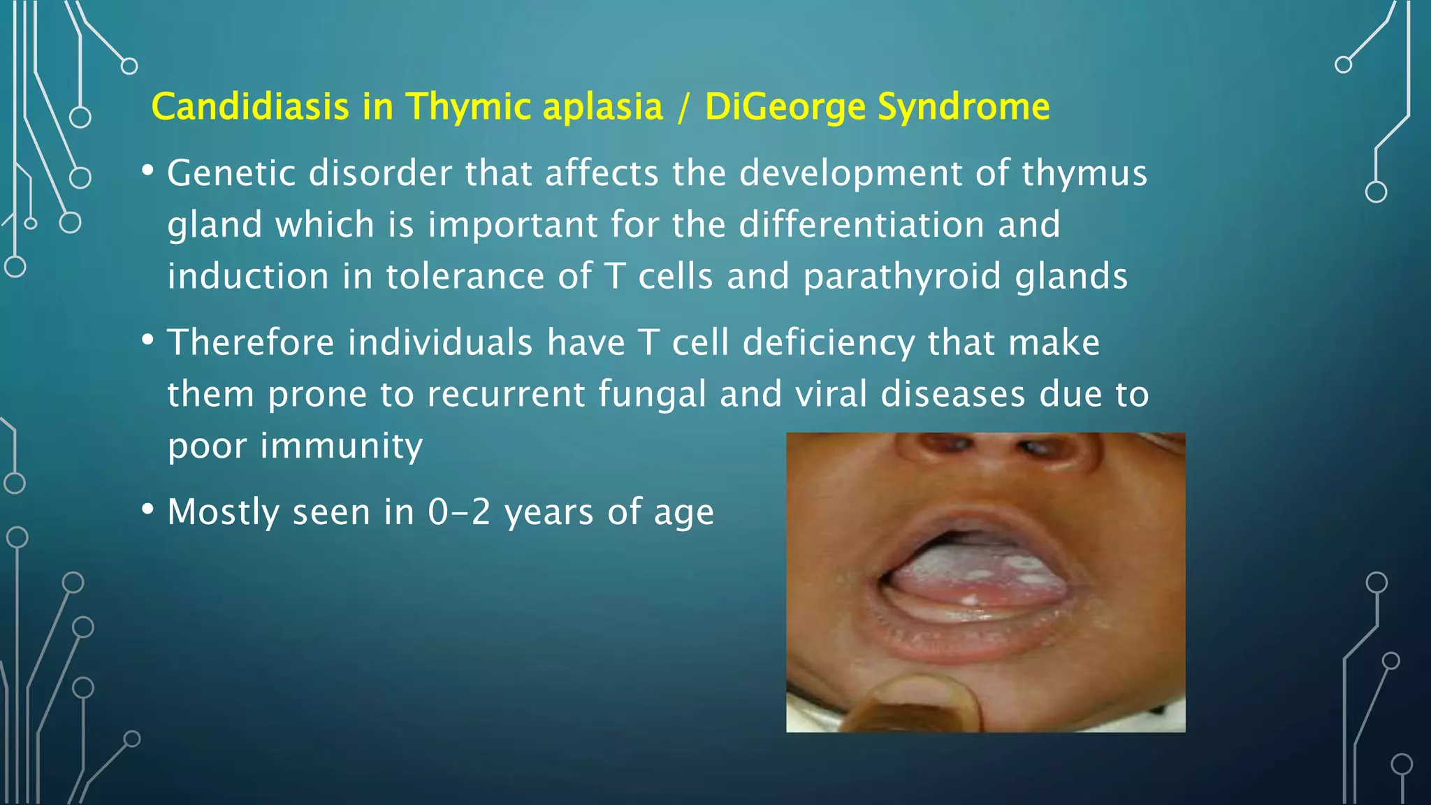 Oral candidiasis | PPTX