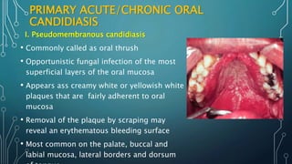 Oral candidiasis | PPTX