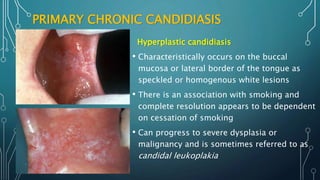 Oral candidiasis | PPT