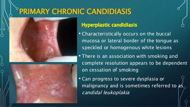 Oral candidiasis