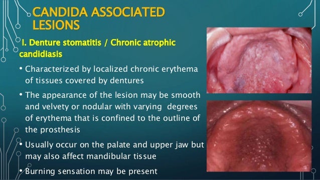 Oral candidiasis