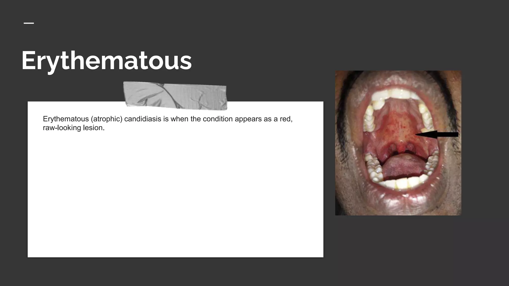 Oral candidiasis.pptx
