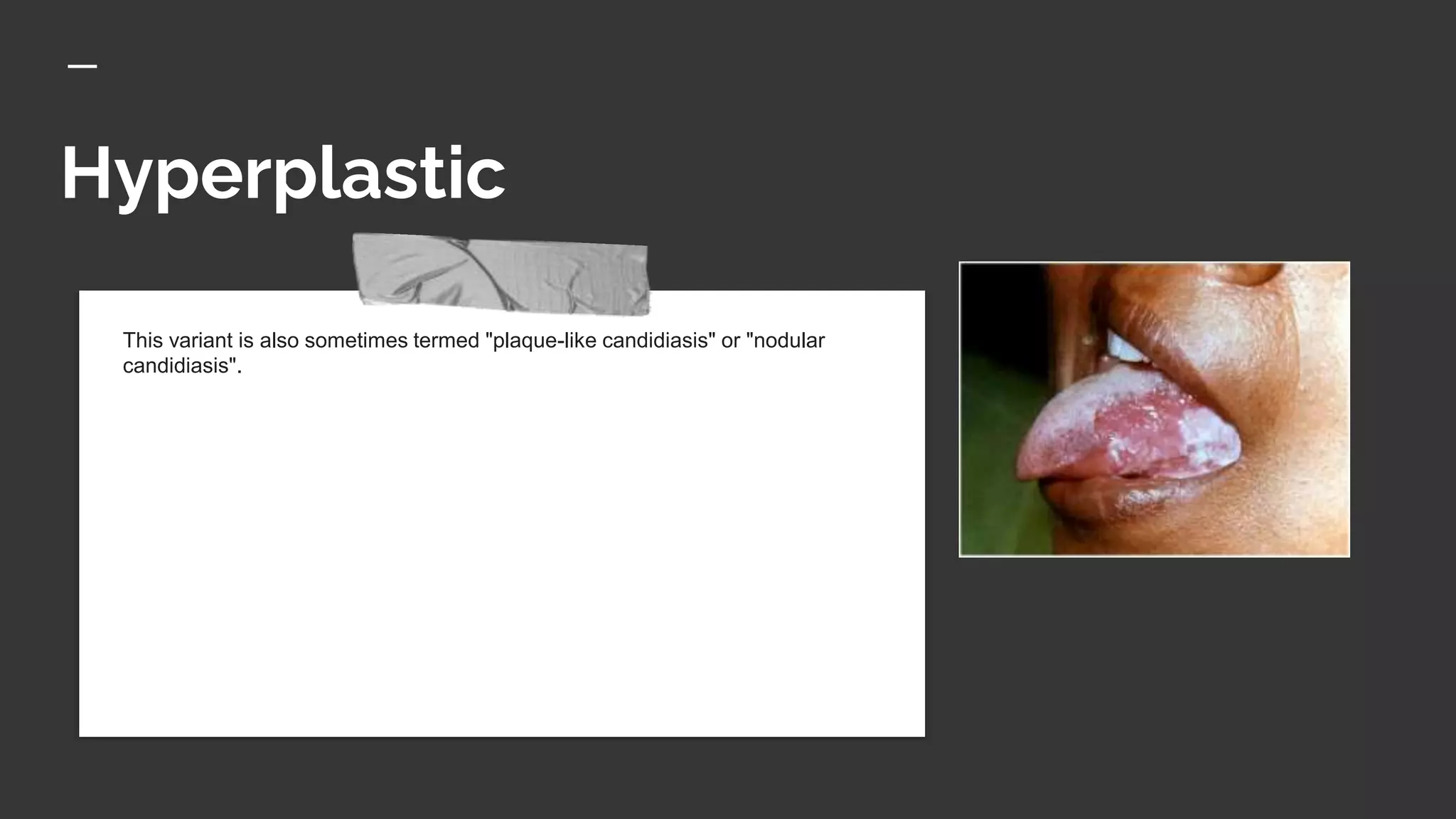 Oral candidiasis.pptx