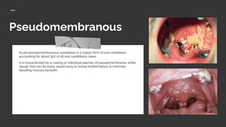Oral candidiasis.pptx