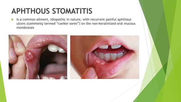 oral candidiasis in pediatric population | PPTX | Dental Health ...