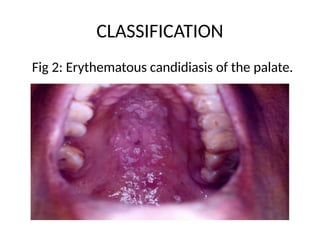 ORAL CANDIDIASIS AND ITS ORAL EFFECTS.pptx