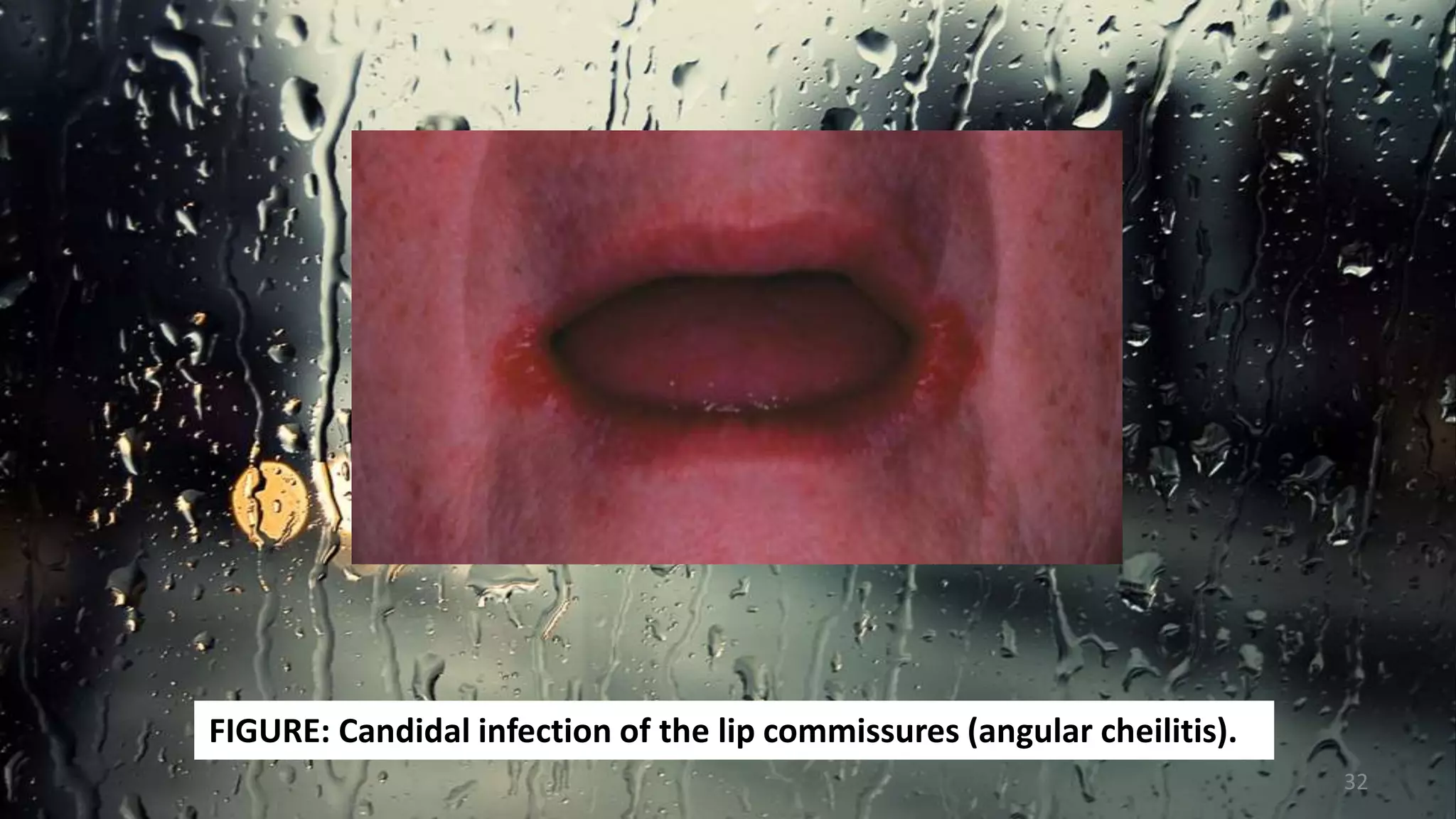 Oral candidiasis | PPTX