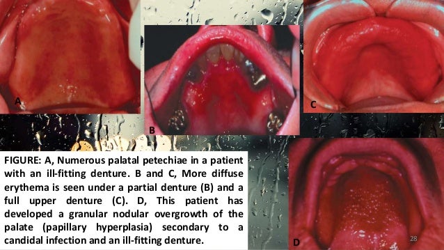 Oral candidiasis