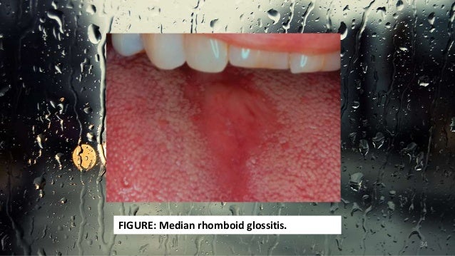 Oral candidiasis