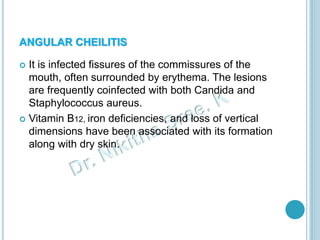 Oral candidiasis | PPTX