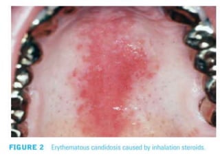 Erythematous Candidiasis