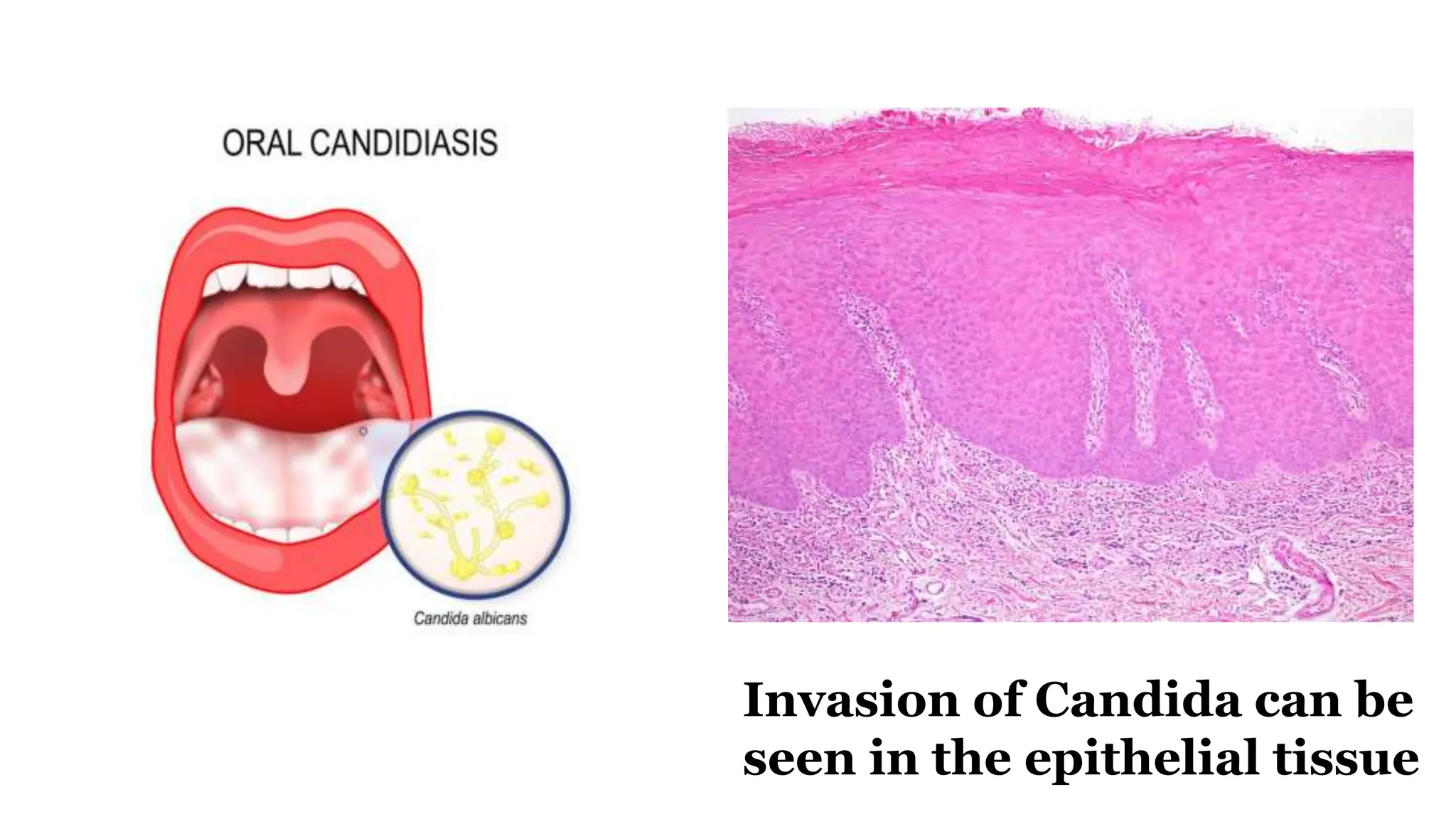 Oral candidiasis and stomatitis. name - seelam Sai charitha .pptx ...