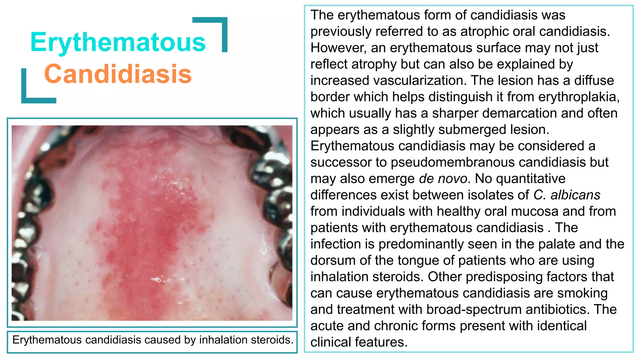 Oral candidiasis by hasan aziz ali | PPTX