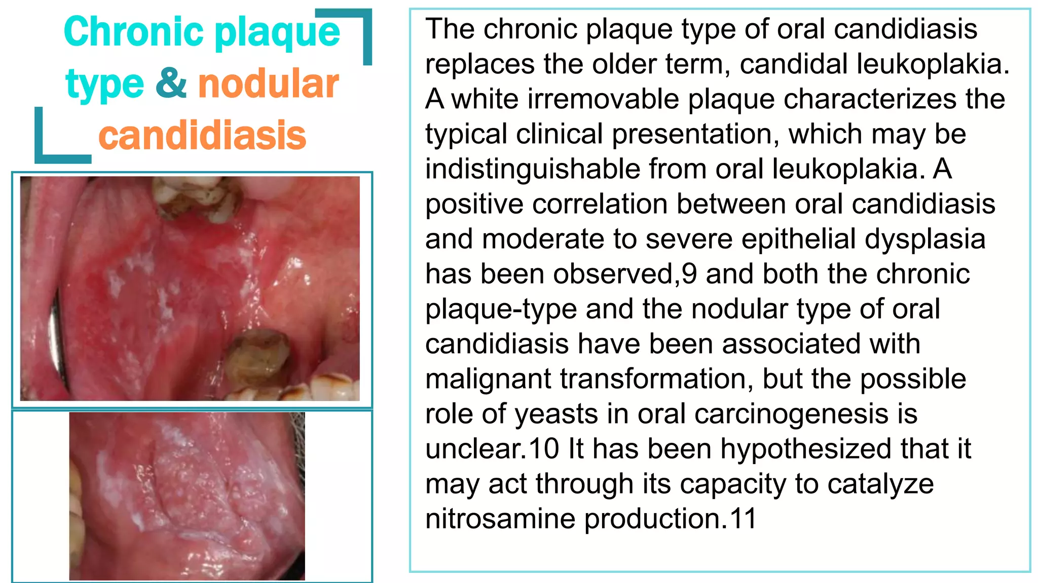 Oral candidiasis by hasan aziz ali | PPTX