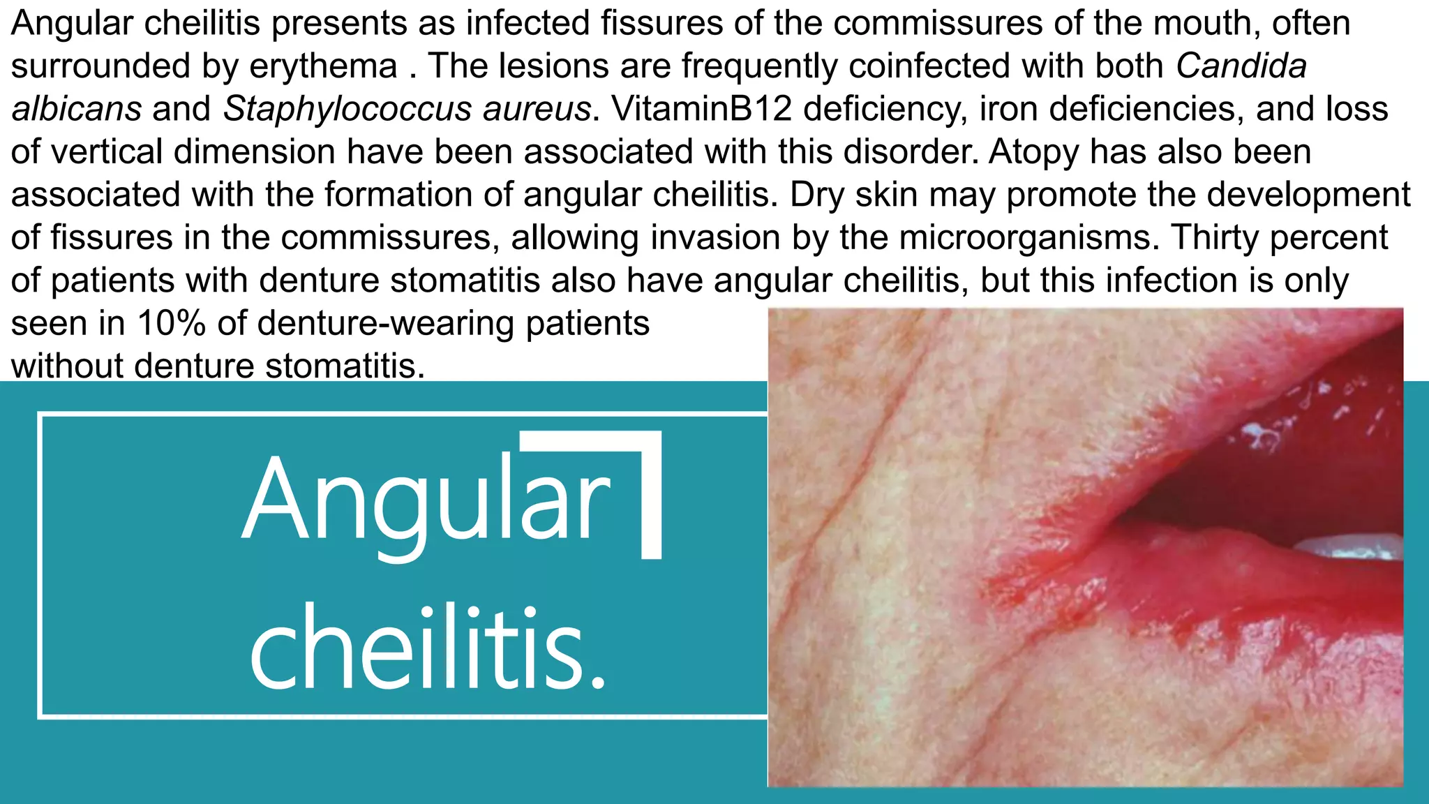 Oral candidiasis by hasan aziz ali | PPTX