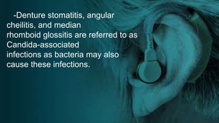 Oral candidiasis by hasan aziz ali | PPT
