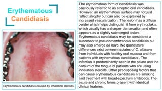 Oral candidiasis by hasan aziz ali | PPT