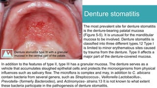Oral candidiasis by hasan aziz ali | PPT