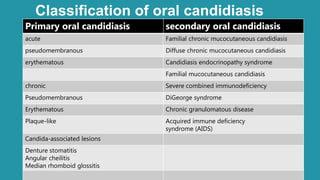 Oral candidiasis by hasan aziz ali | PPT